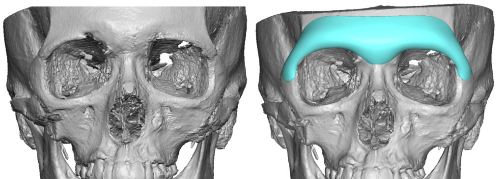 Plastic Surgery Case Study - Placement of Male Custom Brow Bone Implant ...