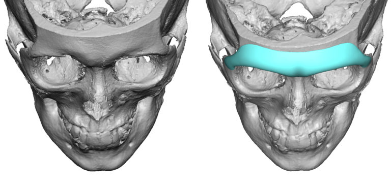 Plastic Surgery Case Study - Placement of Male Custom Brow Bone Implant ...
