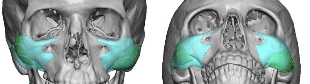 Custom Cheek Implant replacement designs front view Dr Barry Eppley ...