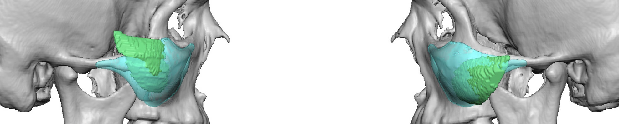 Plastic Surgery Case Study - Male Custom Cheek Implant Replacements for ...