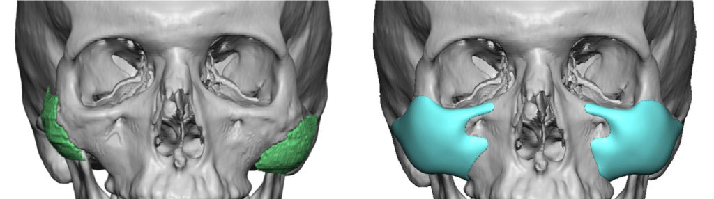 Custom Cheek Implants Replacement design front view Dr Barry Eppley ...