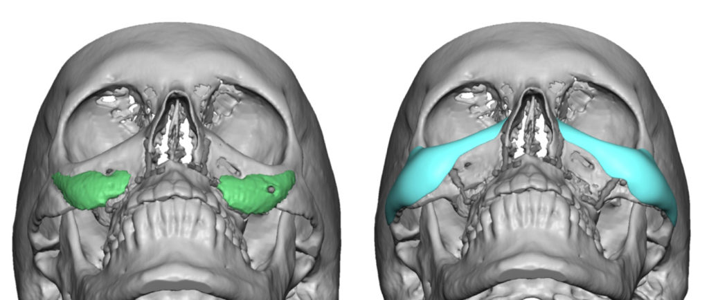 Plastic Surgery Case Study - 3D Custom Infraorbital-Malar Implants ...