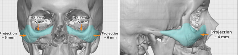 Plastic Surgery Case Study - 3D Custom Infraorbital-Malar Implants ...
