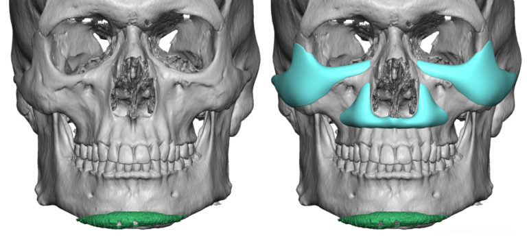 Custom Infraorbital-Malar and Premaxillary-Paransal Implant designs ...