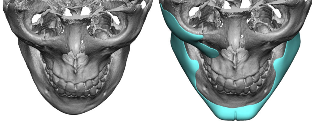 Plastic Surgery Case Study - Custom Right Cheek and Jawline Implant for ...