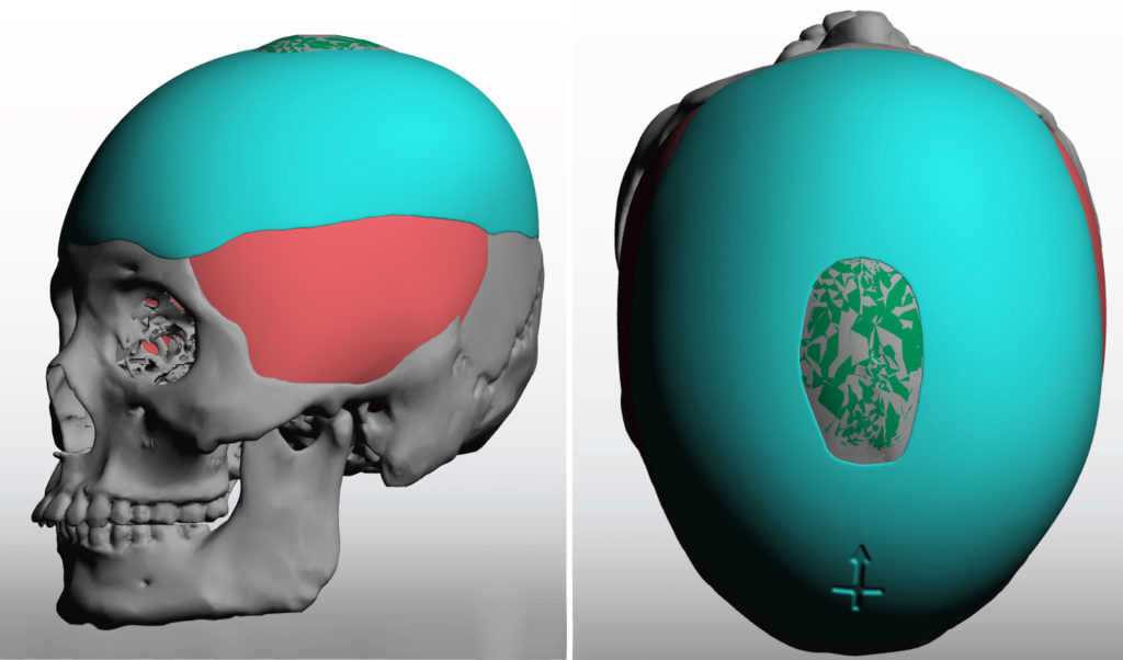 Plastic Surgery Case Study - Reshaping of the Inverted V Sagittal Crest ...