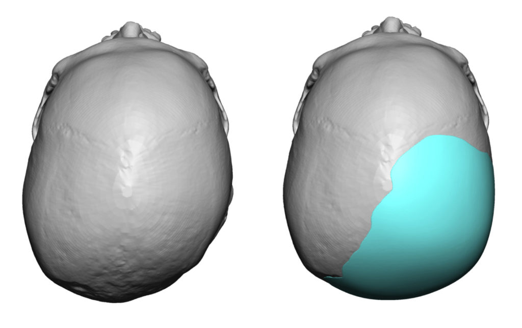 Custom Skull Implant design for Occipital Asymmetry top view Dr Barry ...