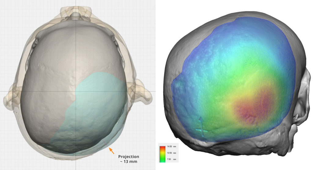 Plastic Surgery Case Study - Custom Occipital-Parietal Skull Implant in ...