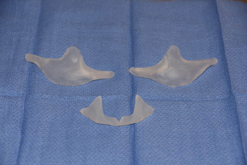 Custom infraorbital-malar and pyriform aperture implants intraop Dr ...