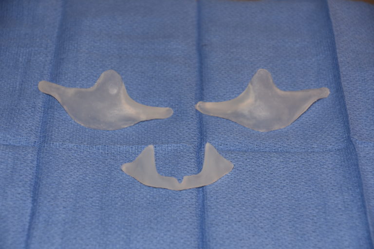 Plastic Surgery Case Study - Combined Custom Infraorbital-Malar and ...