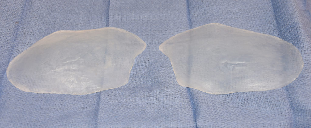 Extended Temporal Head Widening Implants intraop Dr Barry Eppley ...