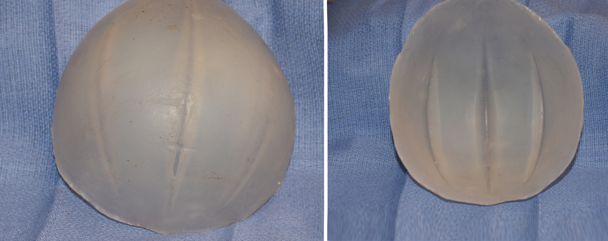 Female Custom Skull Implamnt with internal wedges Dr Barry Eppley ...