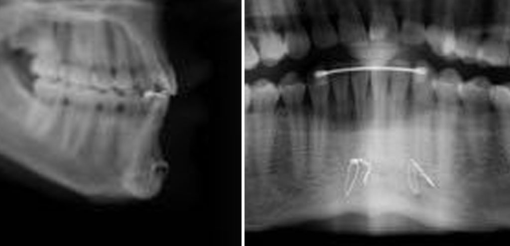 Plastic Surgery Case Study - Submental Chin Reduction after Sliding ...