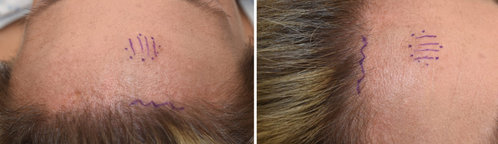 Plastic Surgery Case Study - Forehead Osteoma Removal With A Frontal ...