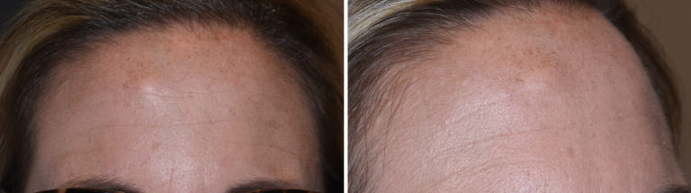 Plastic Surgery Case Study - Forehead Osteoma Removal With A Frontal ...