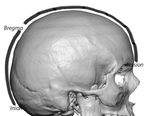 Humans Skull Shapes, The Golden Ratio and Custom Skull Implant Designs ...