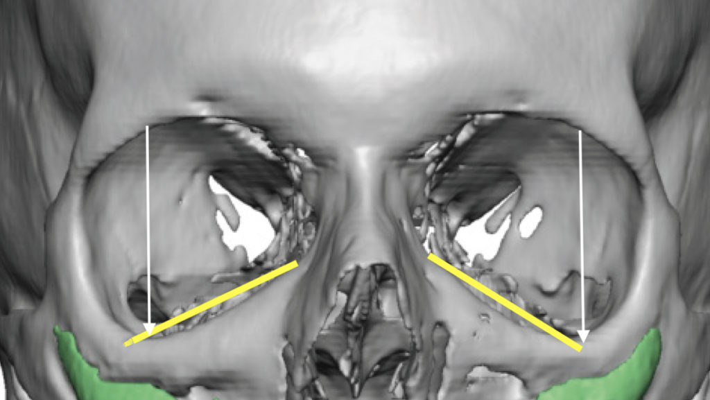 Plastic Surgery Case Study - 3D Custom Infraorbital-Malar Implants ...