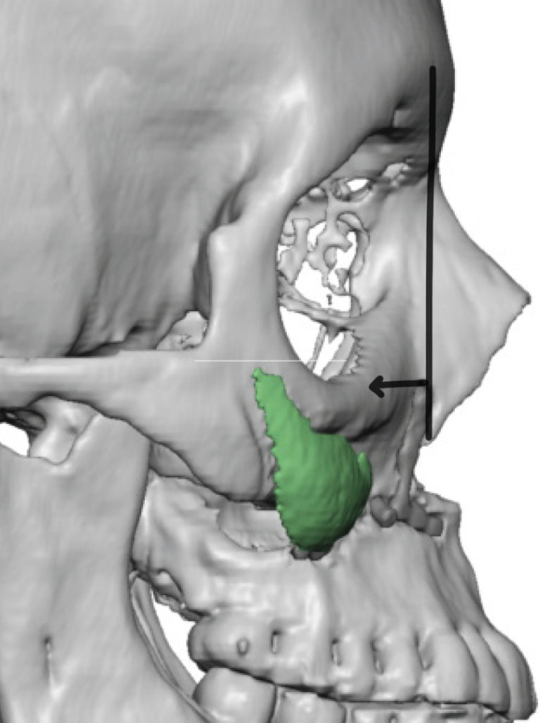 Plastic Surgery Case Study - 3D Custom Infraorbital-Malar Implants ...