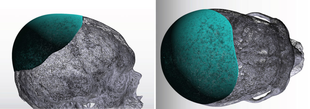 Plastic Surgery Case Study - Adynamic Scalp Expansion with Second Stage ...