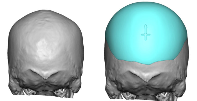 Plastic Surgery Case Study - Adynamic Scalp Expansion with Second Stage ...