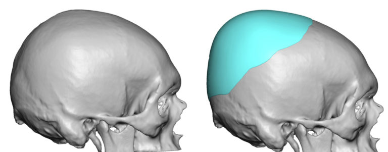 Plastic Surgery Case Study - Adynamic Scalp Expansion with Second Stage ...