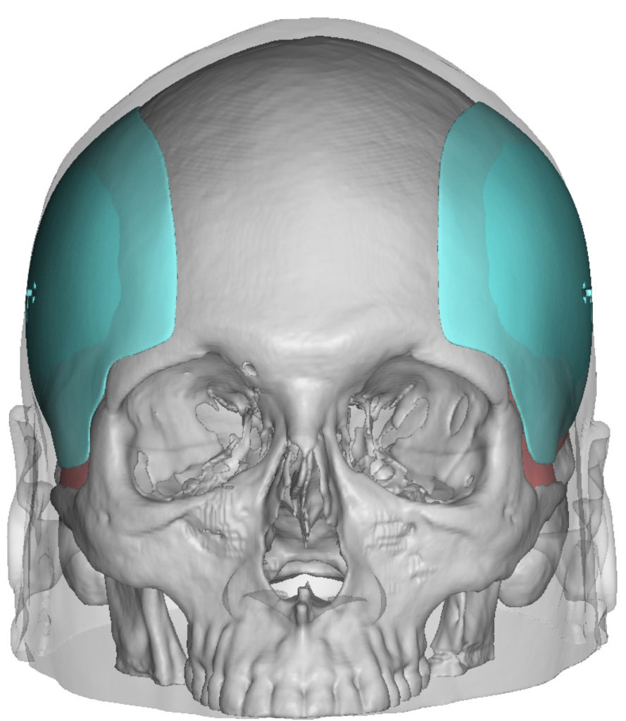 Plastic Surgery Case Study - Custom Temporal Implants For A Complete ...