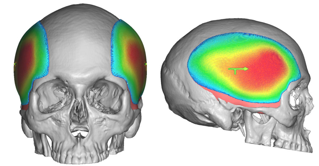 Plastic Surgery Case Study - Custom Temporal Implants For A Complete ...