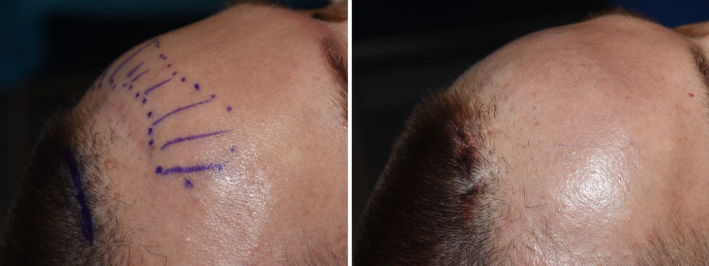 Male Forehead Horn reduction intraop side view - Explore Plastic Surgery