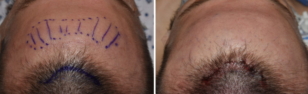 Plastic Surgery Case Study - Reduction of Forehead Prominences (Horns ...