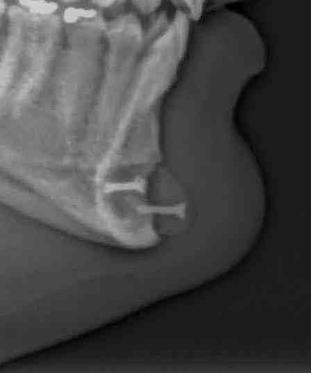 Long-Term Radiographic Assessment of Silicone Chin Implants - Explore ...
