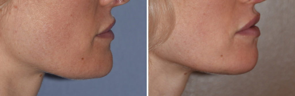 Plastic Surgery Case Study - Submental Chin Reduction after Sliding ...