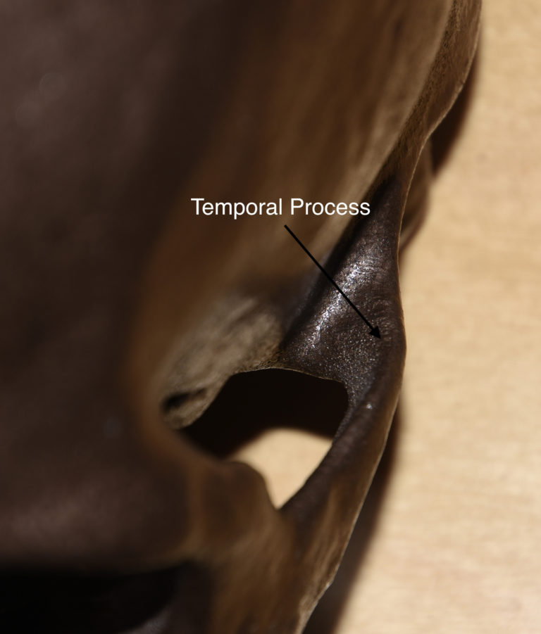 The Posterior Zygomatic Arch Osteotomy Combined With Temporal Process ...