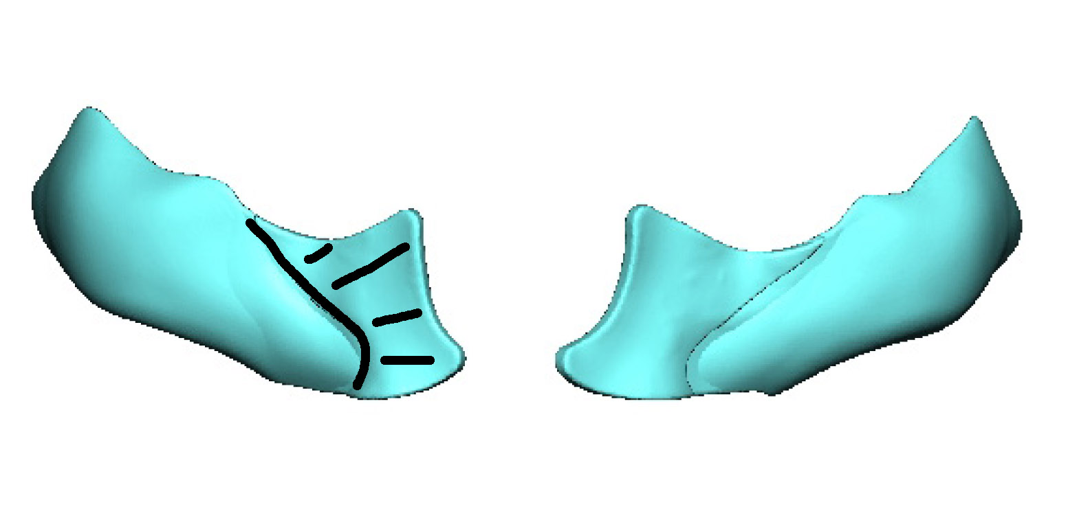 Technical Strategies - Maxillary Placement Tab in Custom Cheek Implants ...