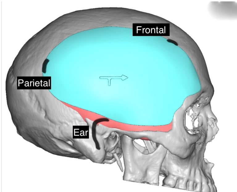 Plastic Surgery Case Study - Custom Temporal Implants For A Complete ...