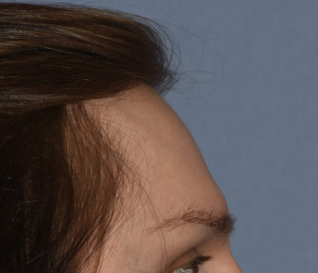 Wide Broad Forehead shape side view Dr Barry Eppley Indianapolis ...