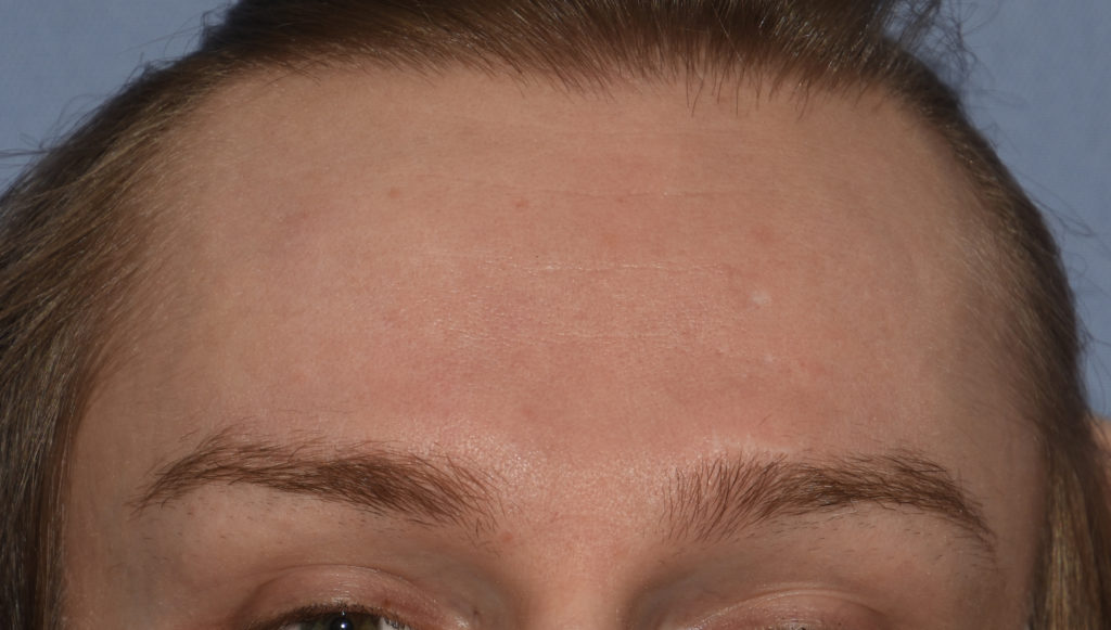 Technical Strategies - Forehead Width Reduction in Transgender Male to ...