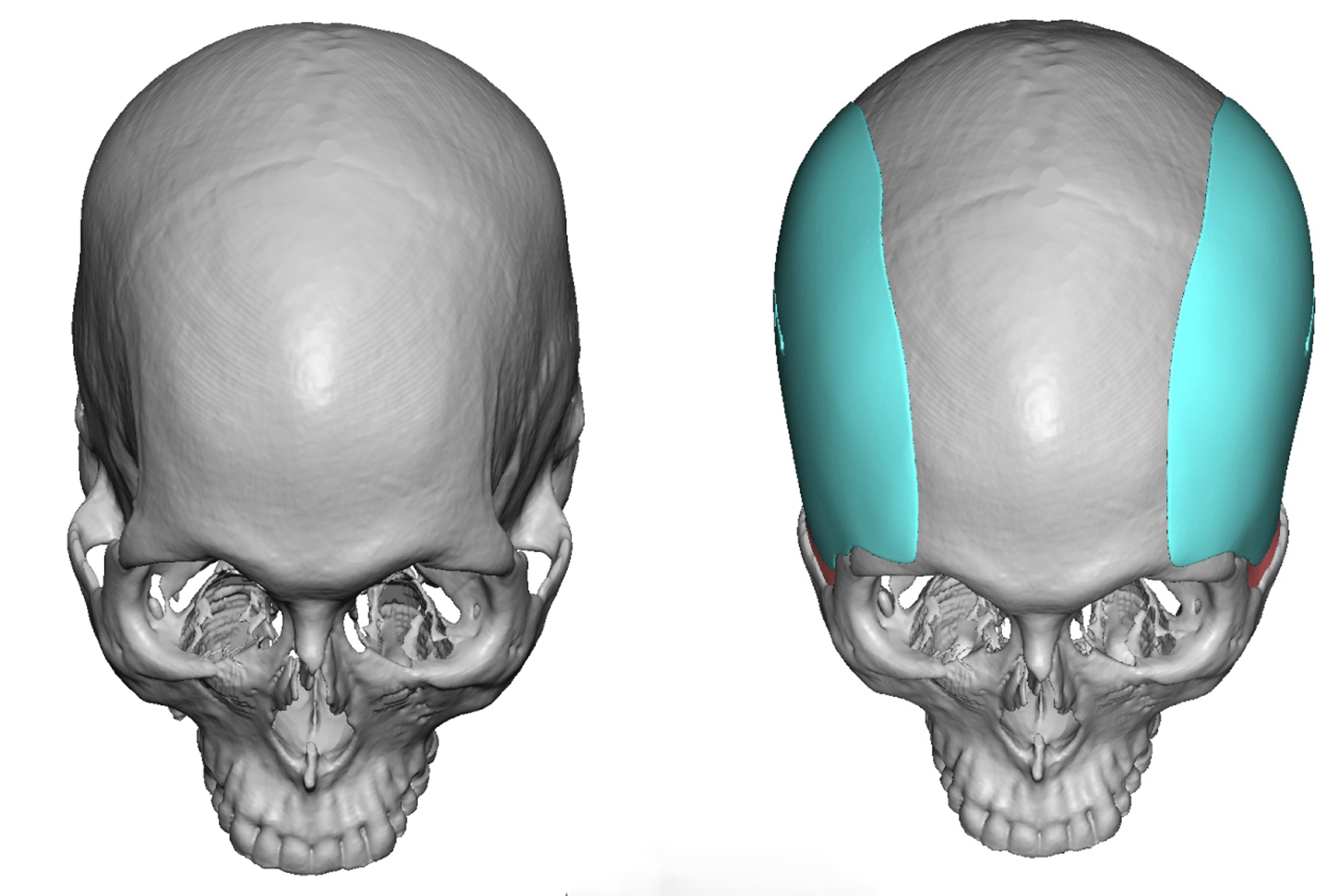 Plastic Surgery Case Study - Custom Temporal Implants For A Complete ...