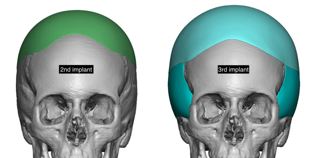 Plastic Surgery Case Study - 3rd Custom Skull Implant for Female Crown ...