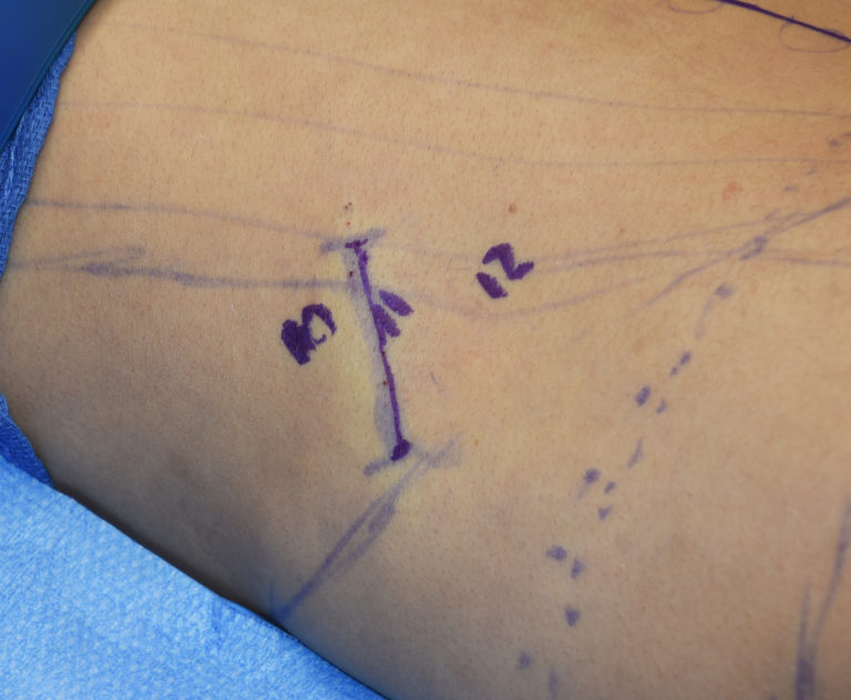 Back Incision Location For Rib Removal Dr Barry Eppley Indianapolis Explore Plastic Surgery