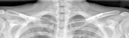 Postoperative Radiographic Assessment of Clavicle Reduction Osteotomies ...