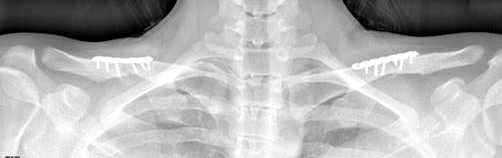 Postoperative Radiographic Assessment of Clavicle Reduction Osteotomies ...