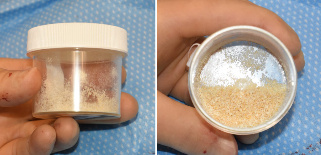 Corticocancellous Bone Graft in Sliding Genioplasty Dr Barry Eppley ...