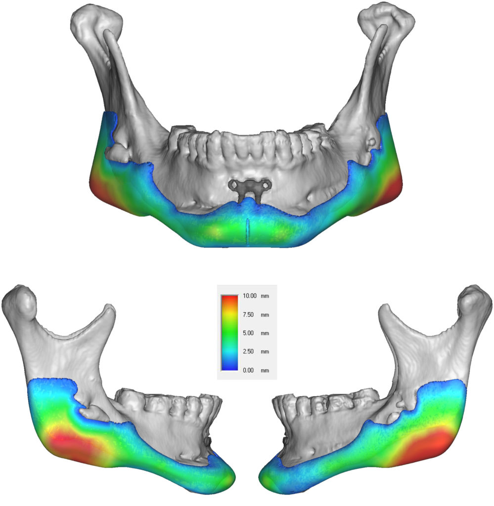 Plastic Surgery Case Study - Custom Jawline Implant Replacement for ...