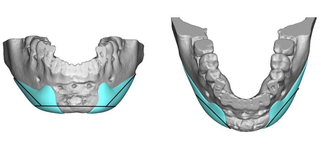 Plastic Surgery Case Study - Submental Vertical Chin Reduction and ...