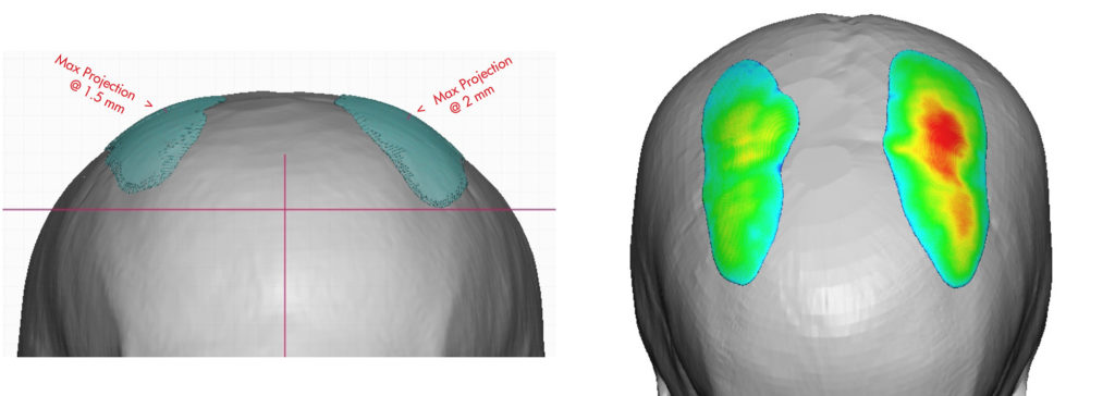 Plastic Surgery Case Study - Custom Parasagittal Skull Implants for ...