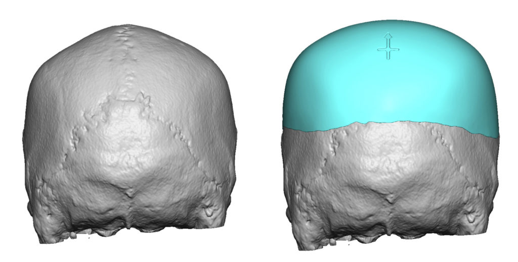 Plastic Surgery Case Study - Male Head Reshaping with a Custom Skull ...
