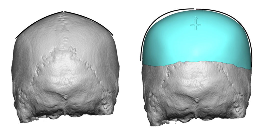 Plastic Surgery Case Study - Male Head Reshaping with a Custom Skull ...