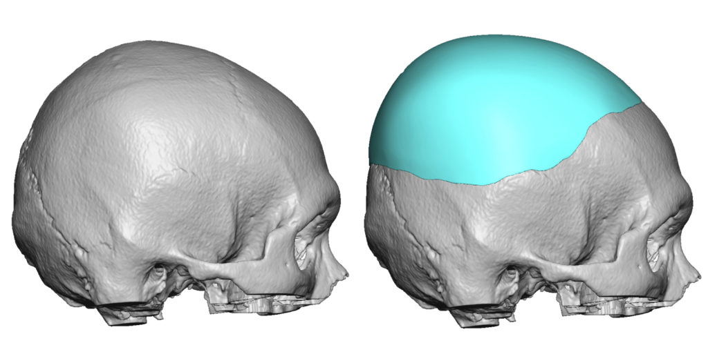 Plastic Surgery Case Study - Male Head Reshaping with a Custom Skull ...