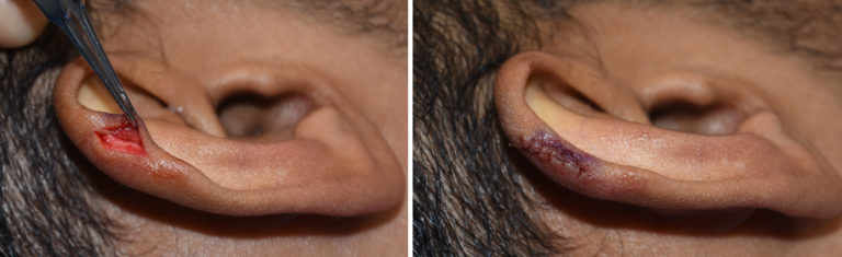 Plastic Surgery Case Study - Excision of Darwin's Tubercles of the Ears ...