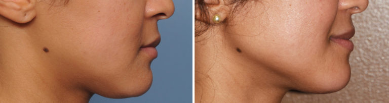 Plastic Surgery Case Study - Female Jaw Angle Implants in Jaw Asymmetry ...